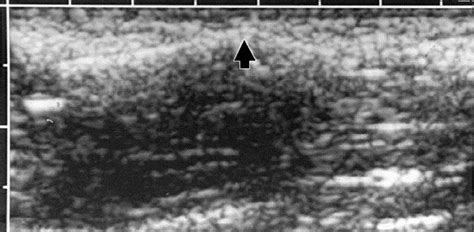 Real Time Ultrasonographically Guided Removal Of Nonpalpable And