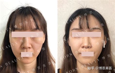泪沟想做填充？但抱歉，那是印第安纹！ 知乎