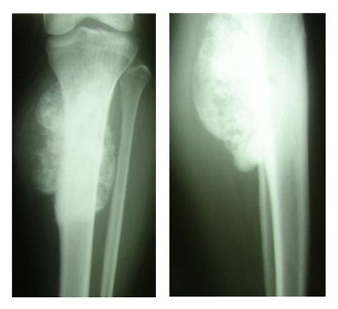 Anterior Posterior And Lateral Radiographs Of The Proximal Tibia Download Scientific Diagram