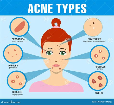 Types Of Acne On Face