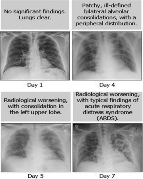 Chest X Ray Image Of COVID Patient Download Scientific Diagram