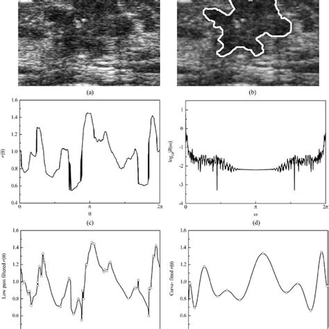Typical Example Of Benign Nodule With A Selected Roi On The Original