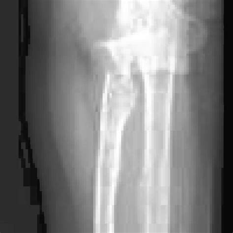 Bone Break Classification Classification Model V2 2024 02 16 4 37pm By Curso