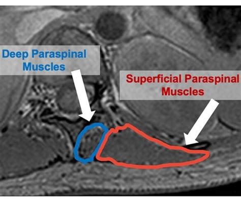 Neuromuscular Control Of Upright Posture In Adolescents With And