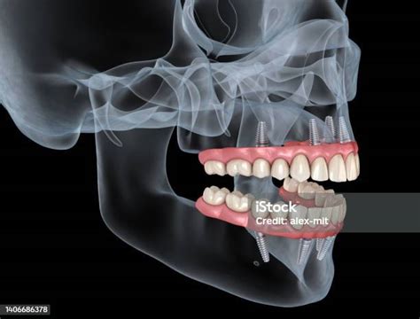 잇몸과 만디블러 보철물로 임플란트가 지원하는 4가지 시스템 인간의 치아와 의치의 의학적으로 정확한 3d 그림 치아 임플란트에 대한 스톡 사진 및 기타 이미지 Istock