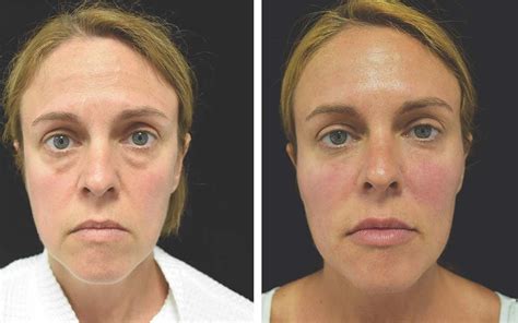 How To Use Makeup Conceal Under Eye Bags