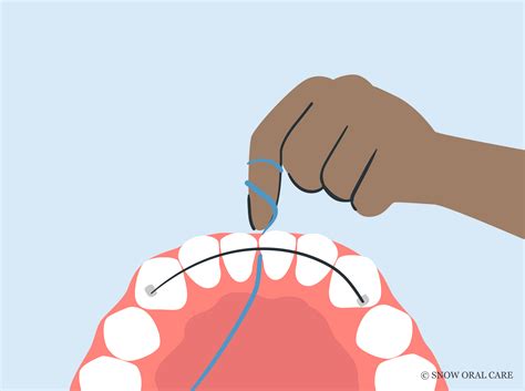 How To Floss With Permanent Retainer Effective Techniques How To Floss With Permanent Retainer Effective Techniques