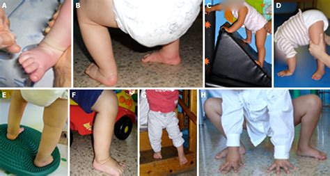 Talipes Equinovarus Exercises At Roberta Warren Blog