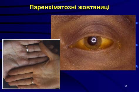 жовтяниці Ppt