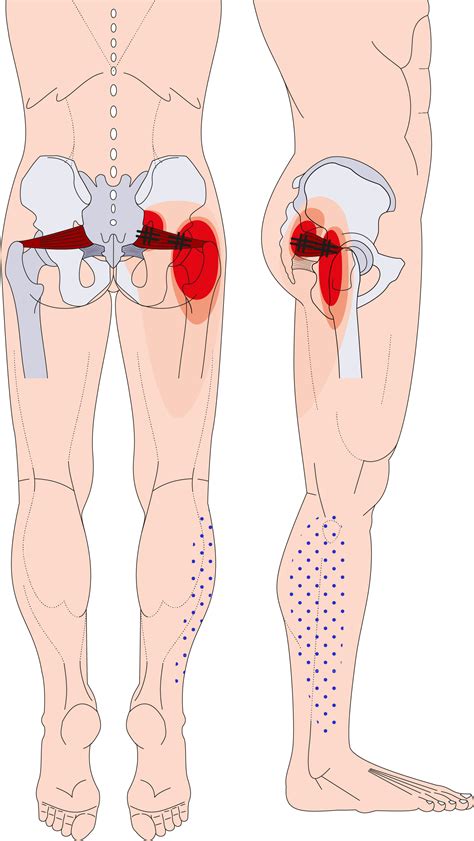 Piriformis Revisited The BMAS Blog
