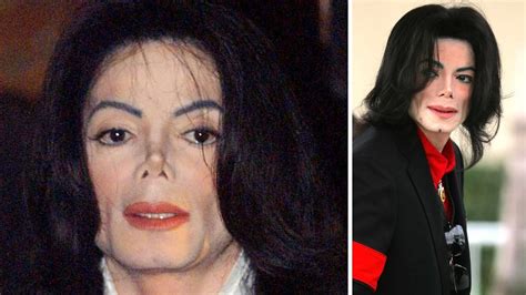 ¿michael Jackson Tenía Cáncer ¿qué Enfermedad Tenía Qué Es Vitiligo