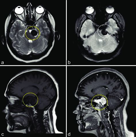 A Axial T2 Weighted B Gradient Recalled Echo Gre C Sagittal