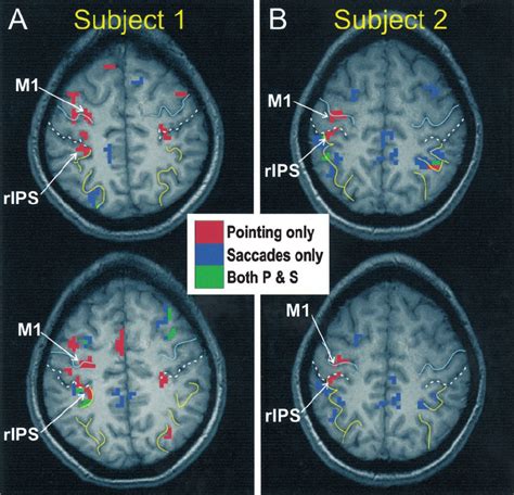A Two Axial Oblique Anatomical Slices Showing Functional Activation
