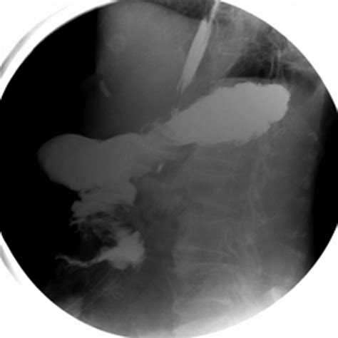 Laparoscopic Duodenojejunostomy For Superior Mesenteric Artery Syndrome