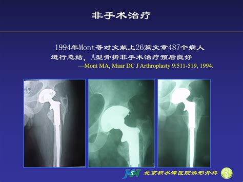 髋关节置换术后股骨假体周围骨折的诊治策略 好医术早读文章 好医术 赋能医生守护生命