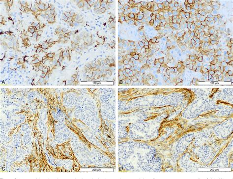 Figure 3 From Podoplanin A Small Glycoprotein With Many Faces Semantic Scholar