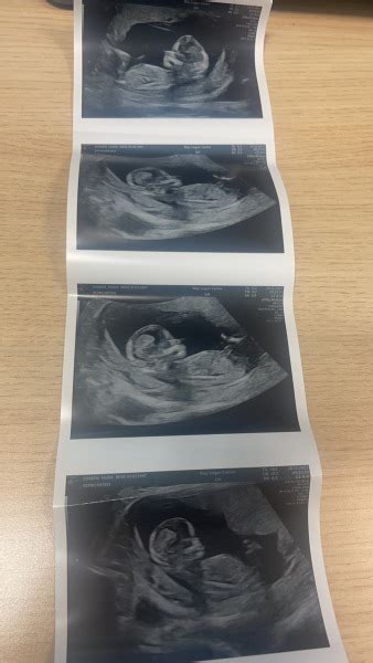 Private Gender Scan At 16 Weeks Mumsnet