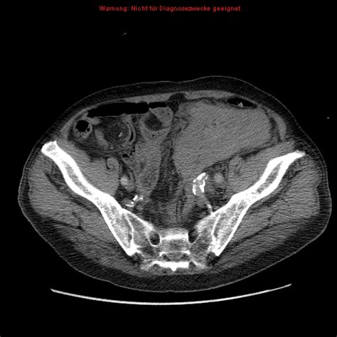 File Abdominal Aortic Aneurysm Extremely Large Ruptured Radiopaedia 19882 19921 Axial C
