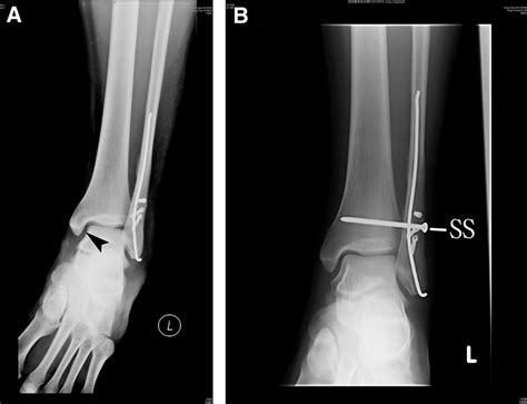 Arthroscopically Assisted Reduction Of Sagittal Plane Disruption Of Download Scientific Diagram