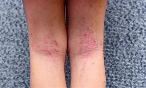 Atopic Dermatitis In Adults Pictures Photos