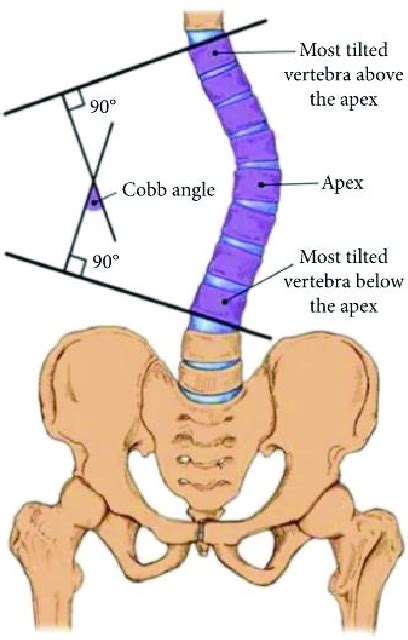 A Schematic View For The Cobb Angle Measurement In The Diagnosis Of