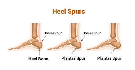 Understanding Heel Spurs Causes Symptoms And Diagnosis
