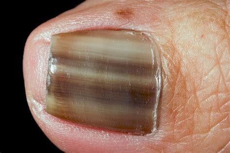 Types Of Skin Cancer And How To Spot Them Jerseys Best