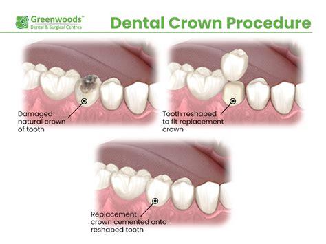 Dental Crown Procedure