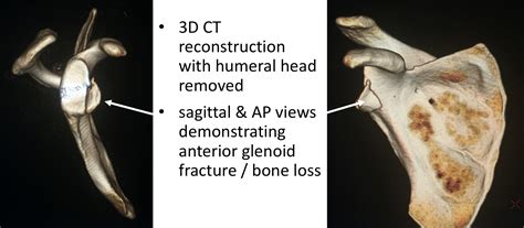 Glenoid Fossa Fracture X Ray At Billy Gamboa Blog