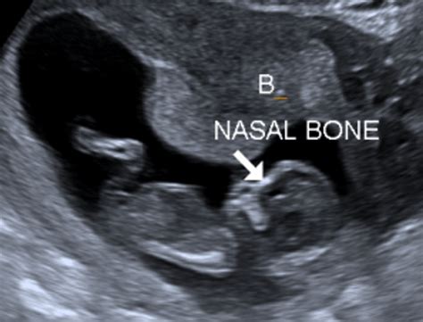 What To Expect At Your 12 Week Ultrasound Erad Radiology