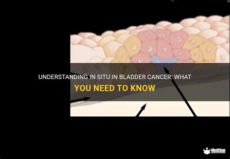 Understanding In Situ In Bladder Cancer What You Need To Know Medshun