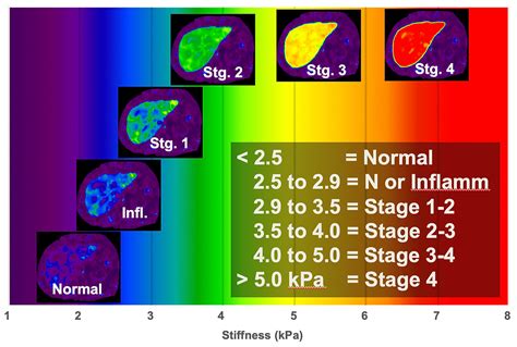 Mre Cut Offs For Liver Fibrosis Assessment