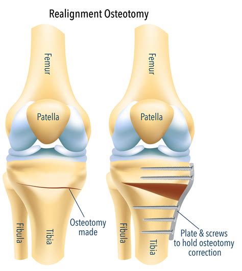 Realignment Osteotomy Surgery Osteotomy Knee Surgery