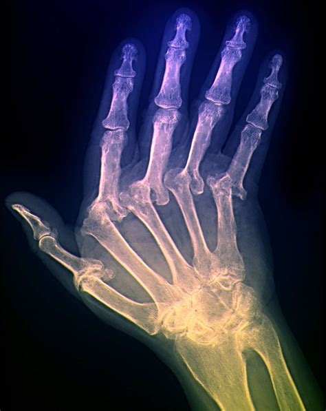 Ulnar Deviation X Ray Radiographic Imaging Of Scaphoid Frx Wheeless