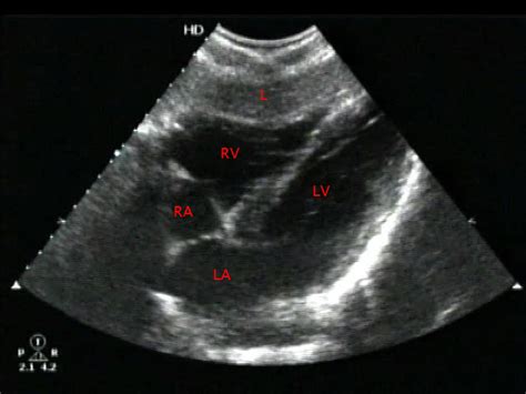 Subxiphoid Ultrasound
