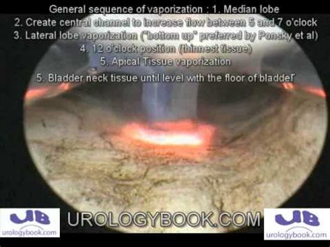 Bipolar Button Plasma Vaporization Of The Prostate BPVP For BPH Urologybook Com YouTube