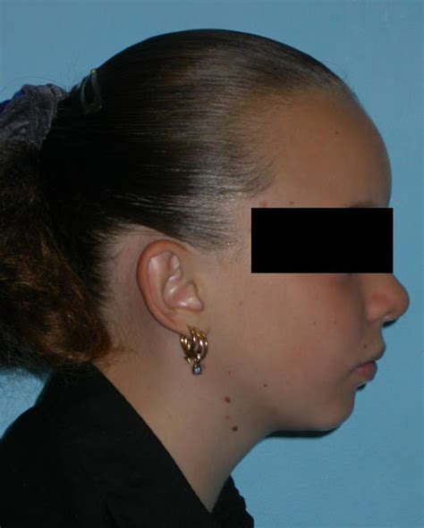 Treating Angle Class Ii Division Ii Malocclusion Deep Overbite