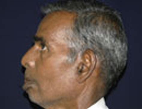 Vascular Malformation Hyderabad Cleft Society