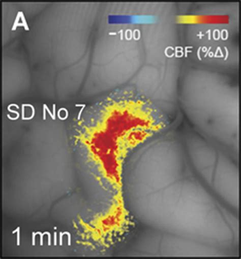 Spotlight On The March 19 Issue Neurology