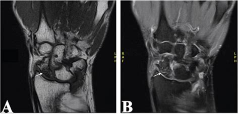Idiopathic Avascular Necrosis Of The Scaphoid Preisers Disease A