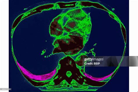 Asbestosis Seen On An Axial Section Chest Scan News Photo Getty Images