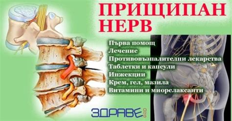 Всичко за Възпален седалищен нерв