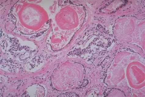 New Blog 1 Cystic Fibrosis Pancreas