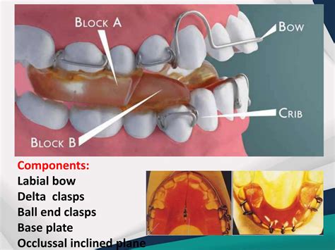 Twin Block Appliance In Orthodontics Pptx