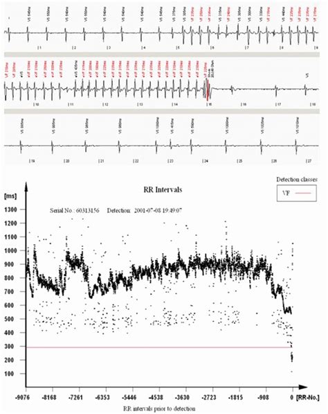 Icd Stored Electrogram And Rr Pattern Before And Following Icd Download Scientific Diagram