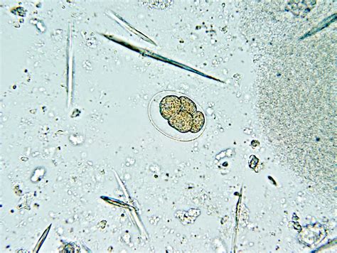 Pathology Outlines Hookworm