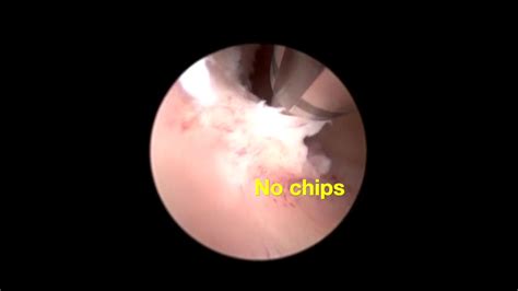 41 Hysteroscopic Polypectomy With Truclear Elite In Office Youtube