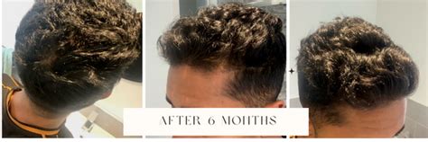Finasteride Before And After Images