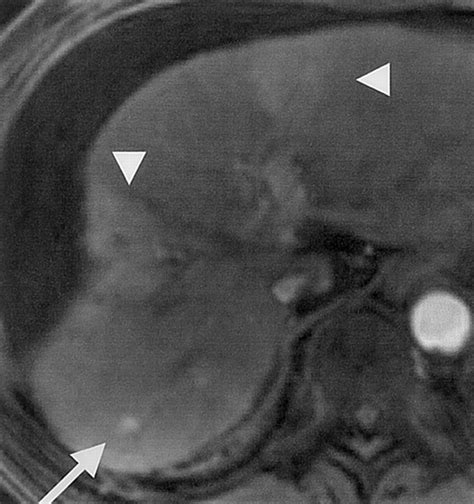 Cirrhosis Or Chronic Hepatitis Evaluation Of Small ≤2 Cm Early