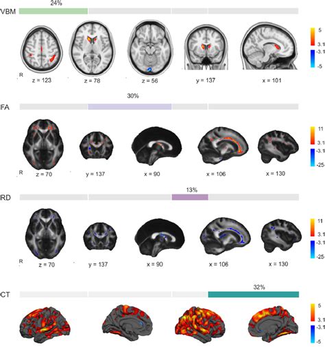 Spatial Maps Of Each Modality In Component 2 The Percentage Of Download Scientific Diagram